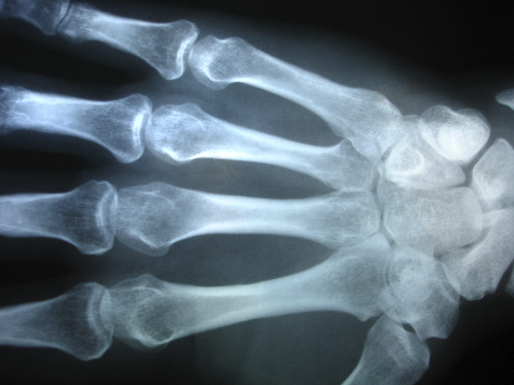 bone-xray - Bone Health & Osteoporosis Foundation