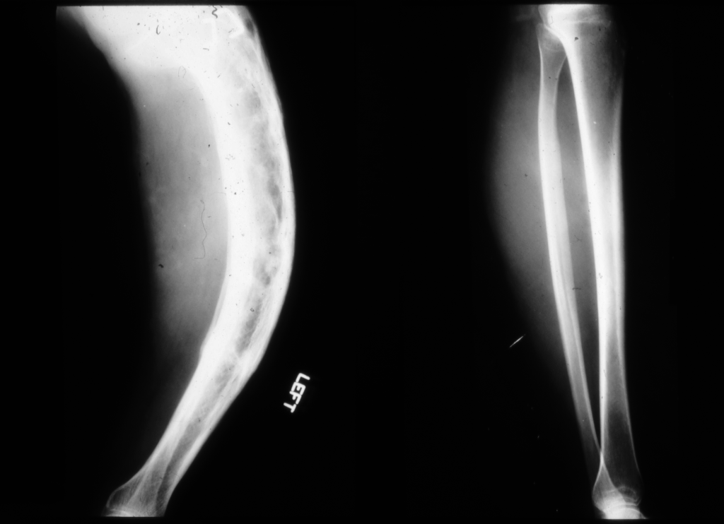 paget-xray-leg - Bone Health & Osteoporosis Foundation