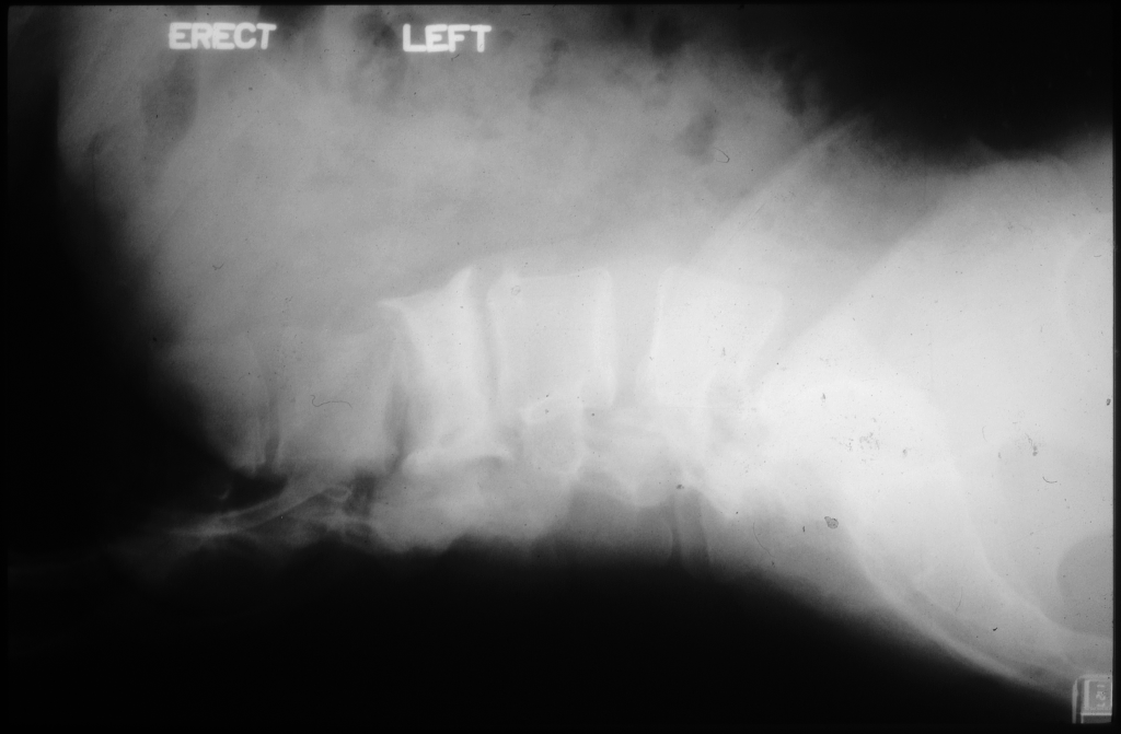 paget-xray-vertebra - Bone Health & Osteoporosis Foundation